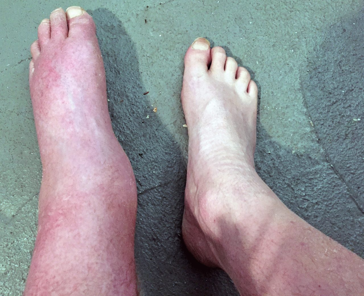 What Is Edema YourCareEverywhere