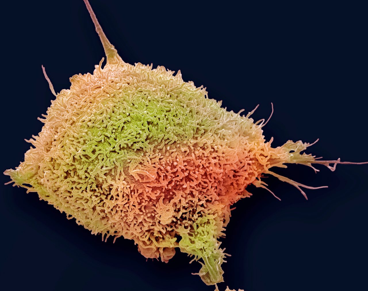 Cases of Late-Stage Cervical Cancer Are Rising | YourCareEverywhere Cases of Late-Stage Cervical Cancer Are Rising | YourCareEverywhere