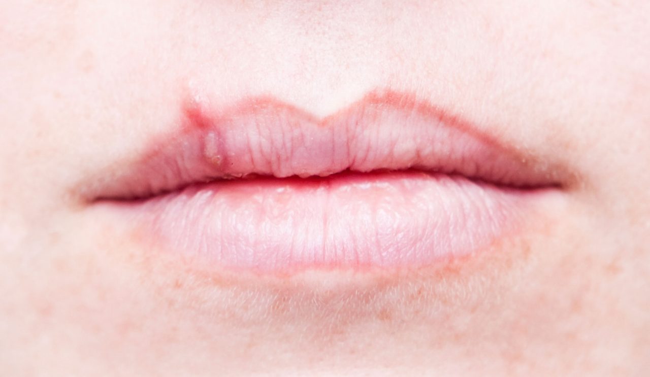 Fever Blisters On Lips Are They Contagious | Lipstutorial.org